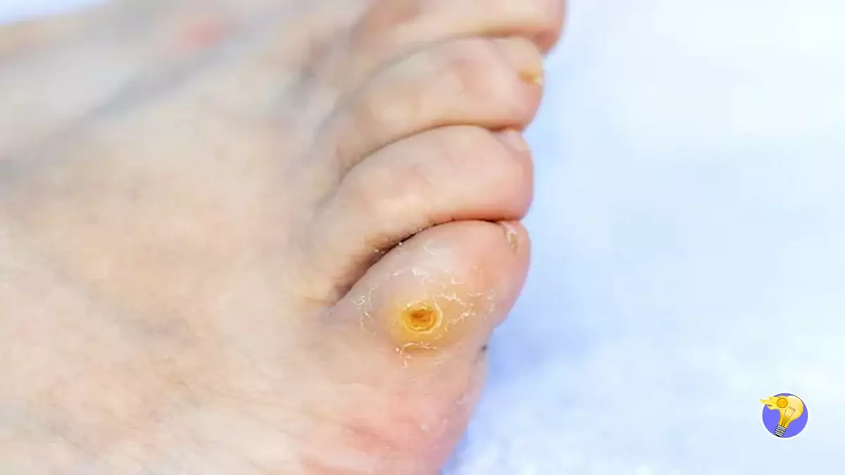 7 Produits Naturels Pour Soigner le Cor au Pied
